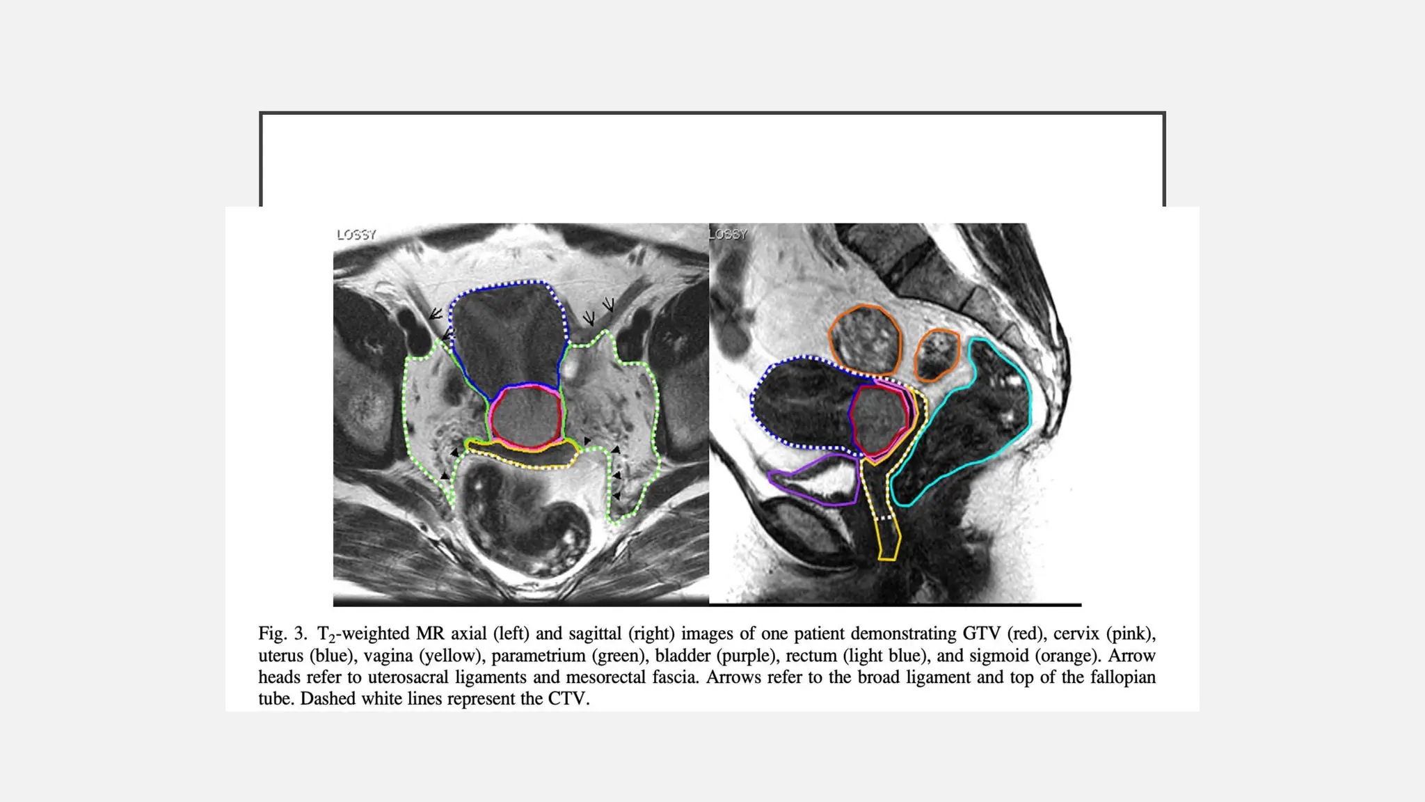 contouring guidelines ca cervix.pdf