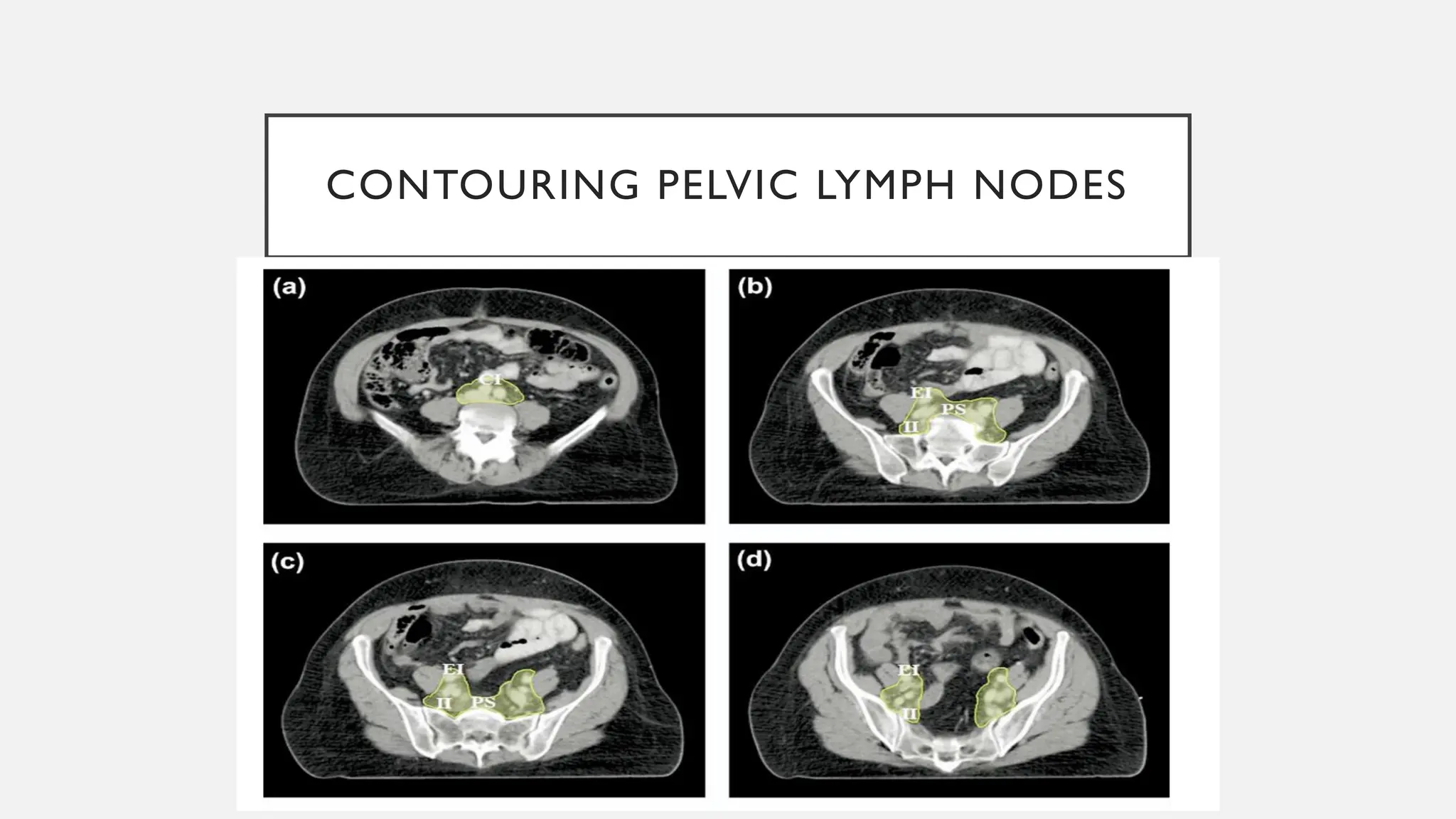 contouring guidelines ca cervix.pdf