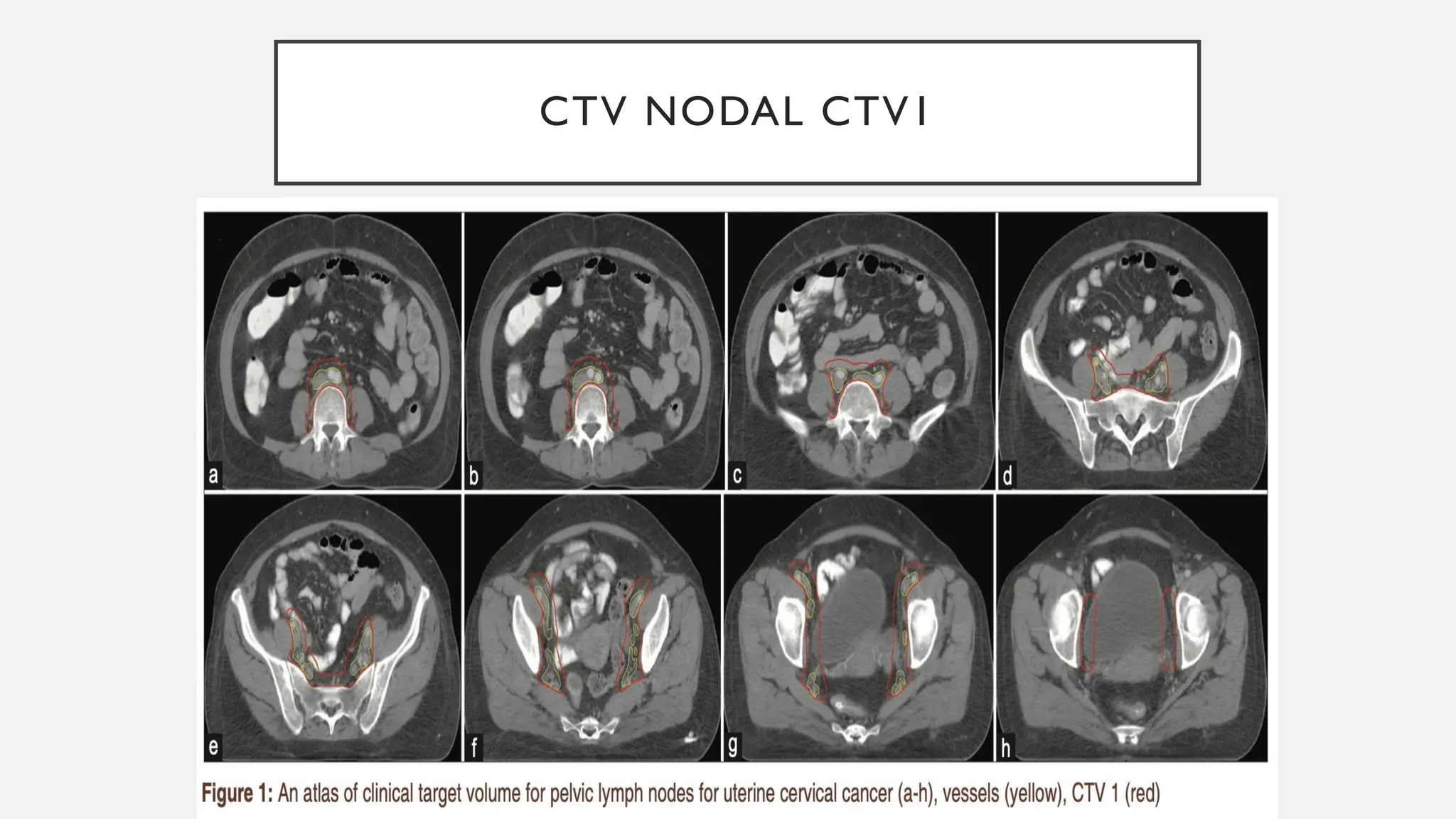 contouring guidelines ca cervix.pdf