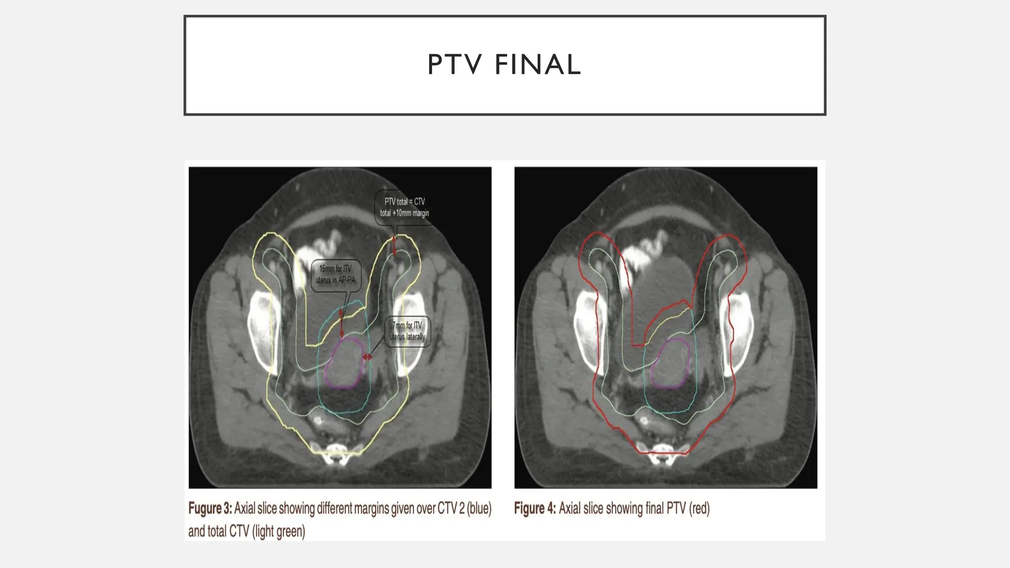 contouring guidelines ca cervix.pdf