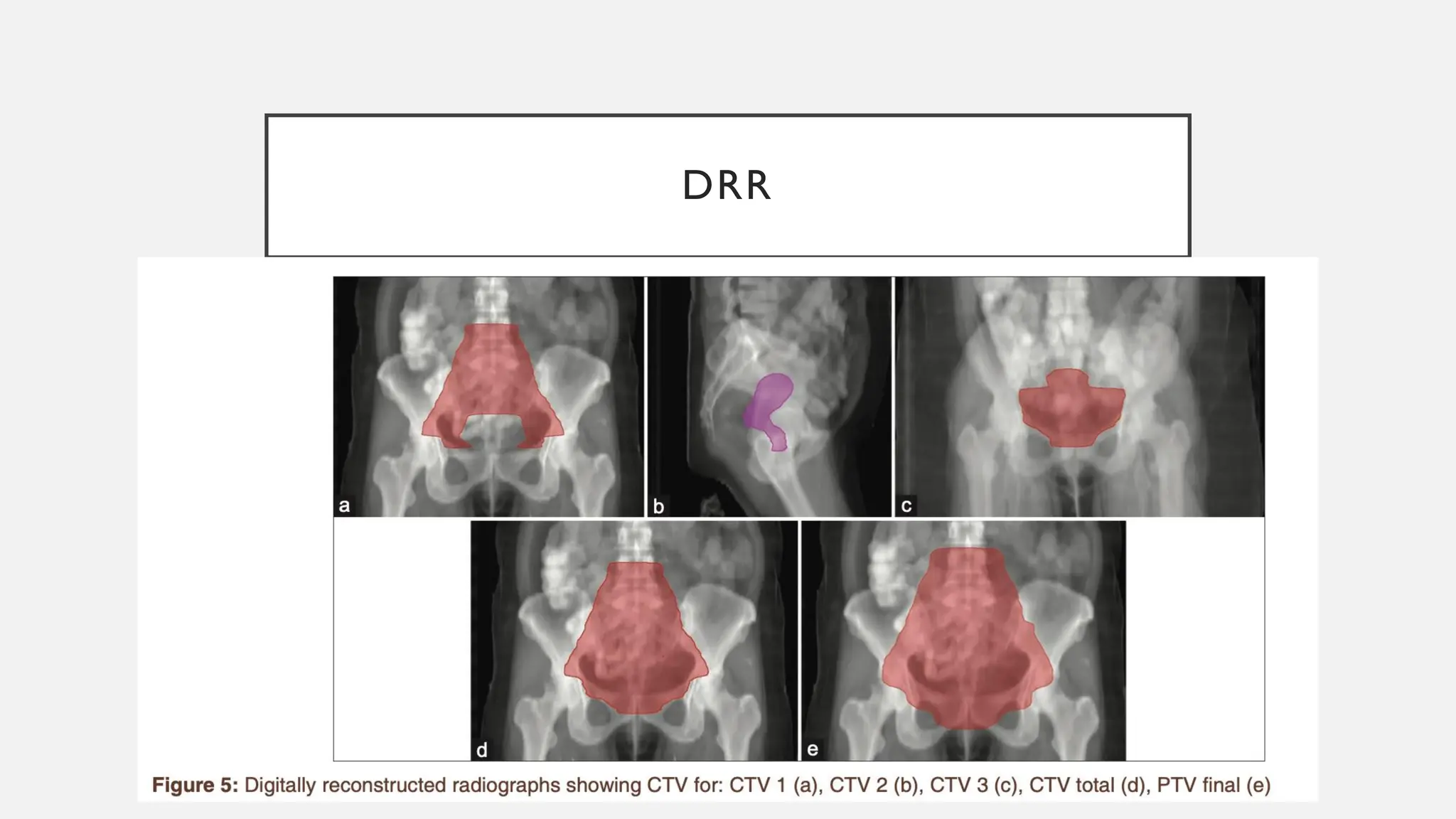 contouring guidelines ca cervix.pdf