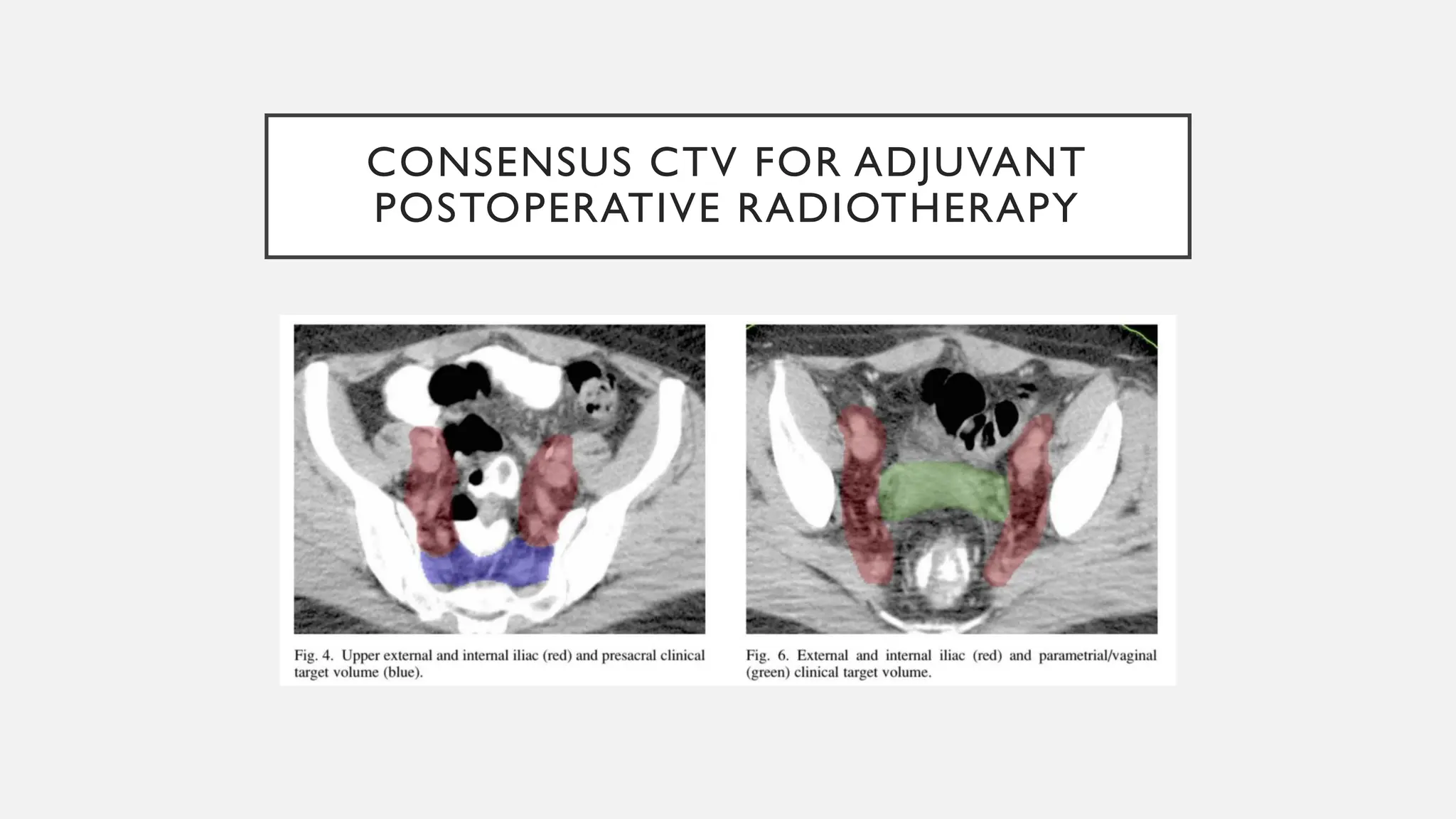 contouring guidelines ca cervix.pdf