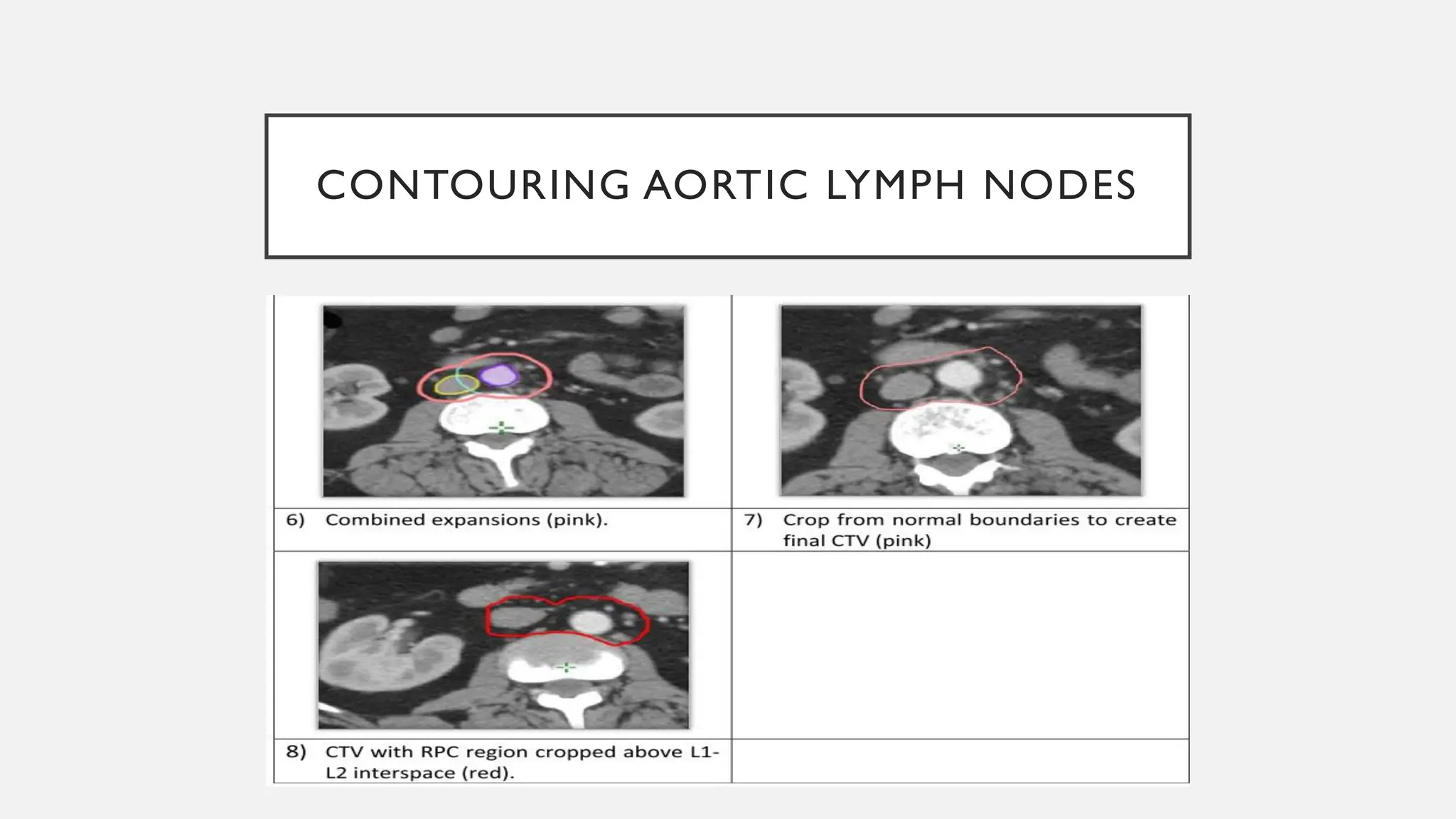 contouring guidelines ca cervix.pdf