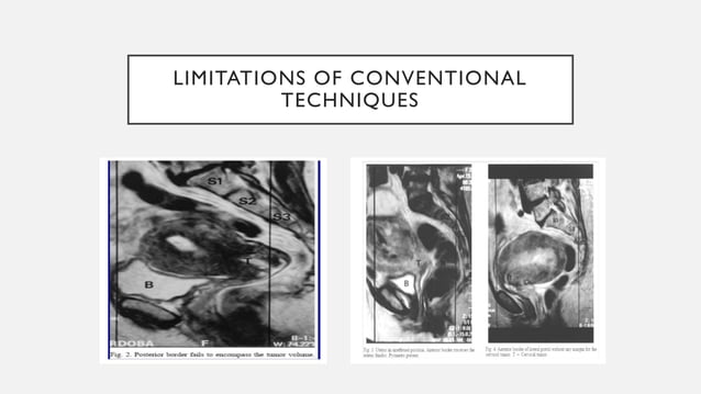 contouring guidelines ca cervix.pdf | Cancer | Diseases and Conditions