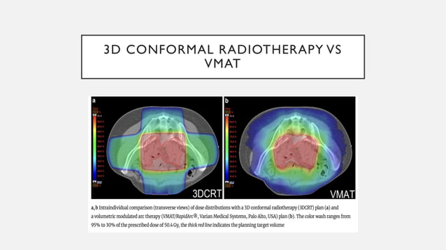 contouring guidelines ca cervix.pdf | Cancer | Diseases and Conditions