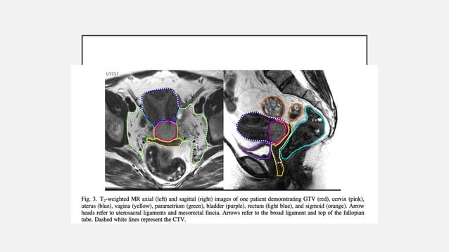 contouring guidelines ca cervix.pdf | Cancer | Diseases and Conditions