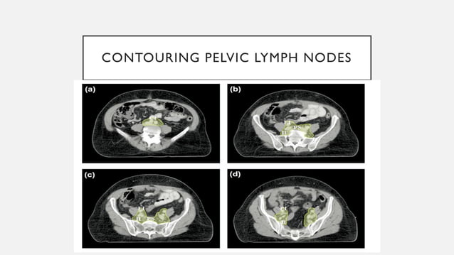 contouring guidelines ca cervix.pdf | Cancer | Diseases and Conditions