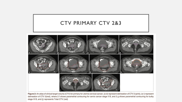 contouring guidelines ca cervix.pdf | Cancer | Diseases and Conditions