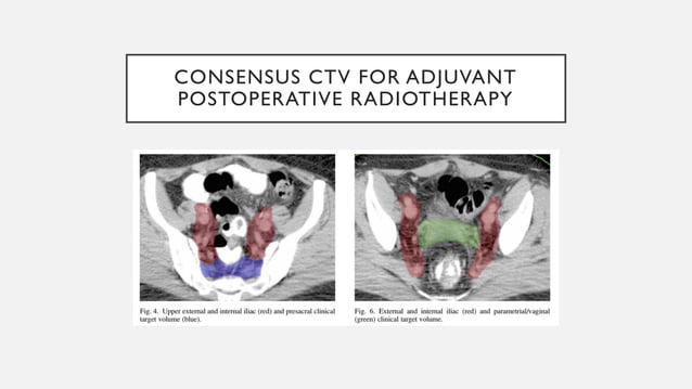 contouring guidelines ca cervix.pdf | Cancer | Diseases and Conditions