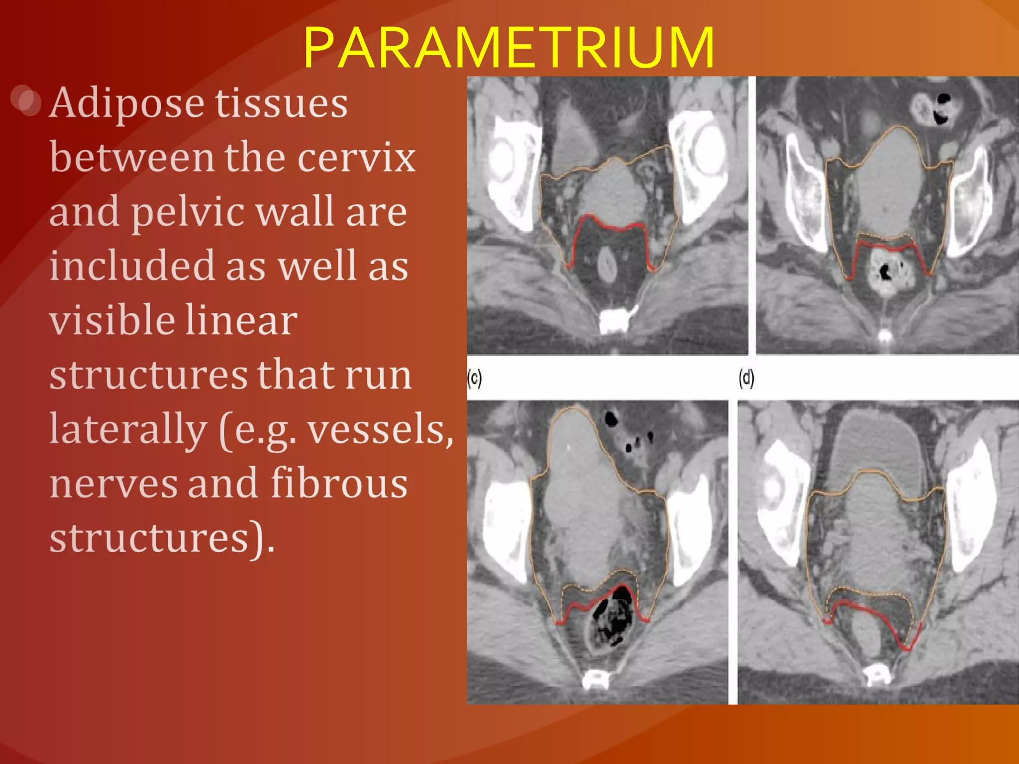 Contouring guidelines of carcinoma cervix | PPT