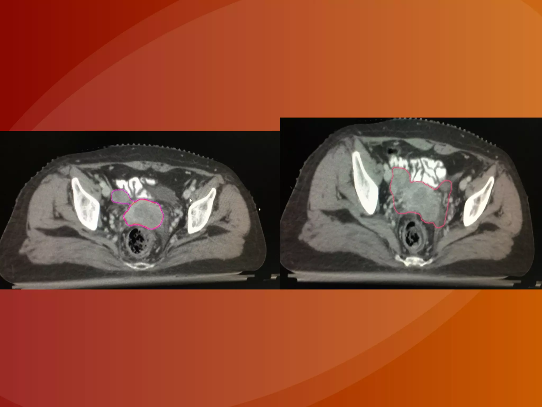 Contouring guidelines of carcinoma cervix | PPT