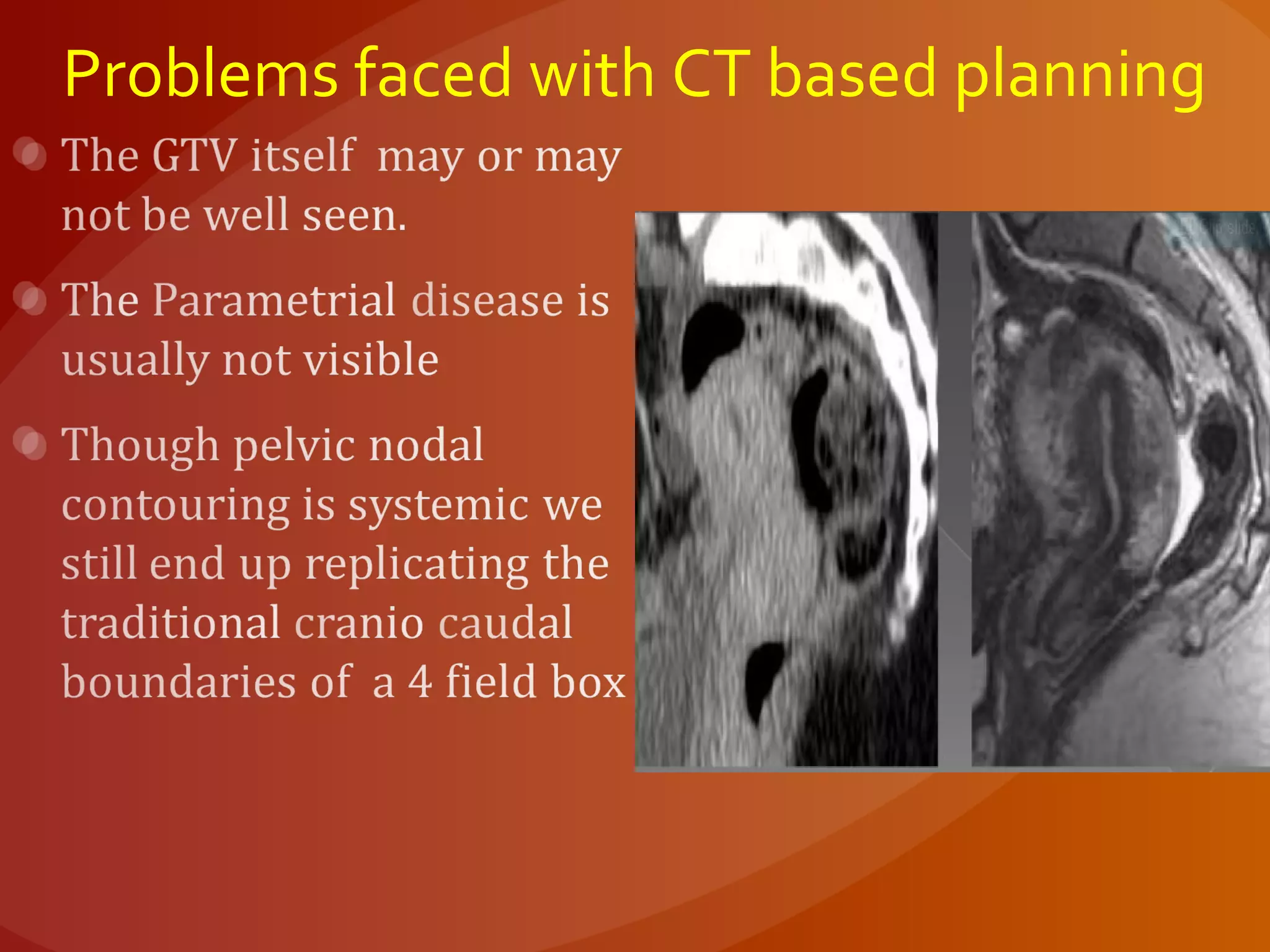 Contouring guidelines of carcinoma cervix | PPT