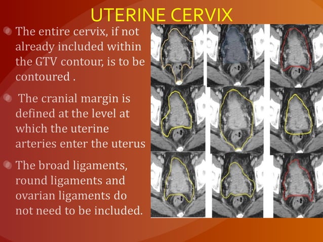 Contouring guidelines of carcinoma cervix | PPT