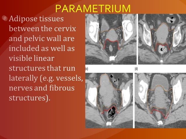 Contouring guidelines of carcinoma cervix | PPT