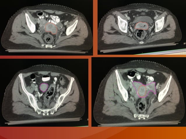 Contouring guidelines of carcinoma cervix | PPT