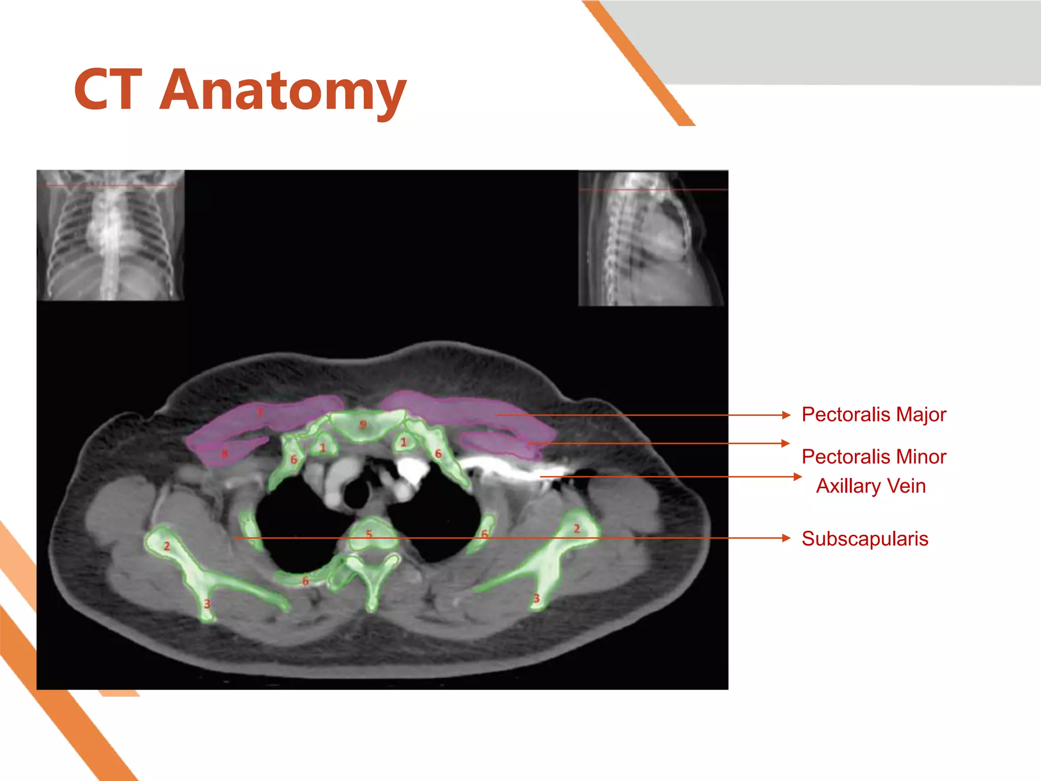 Contouring in breast cancer current practice and future directions | PPTX