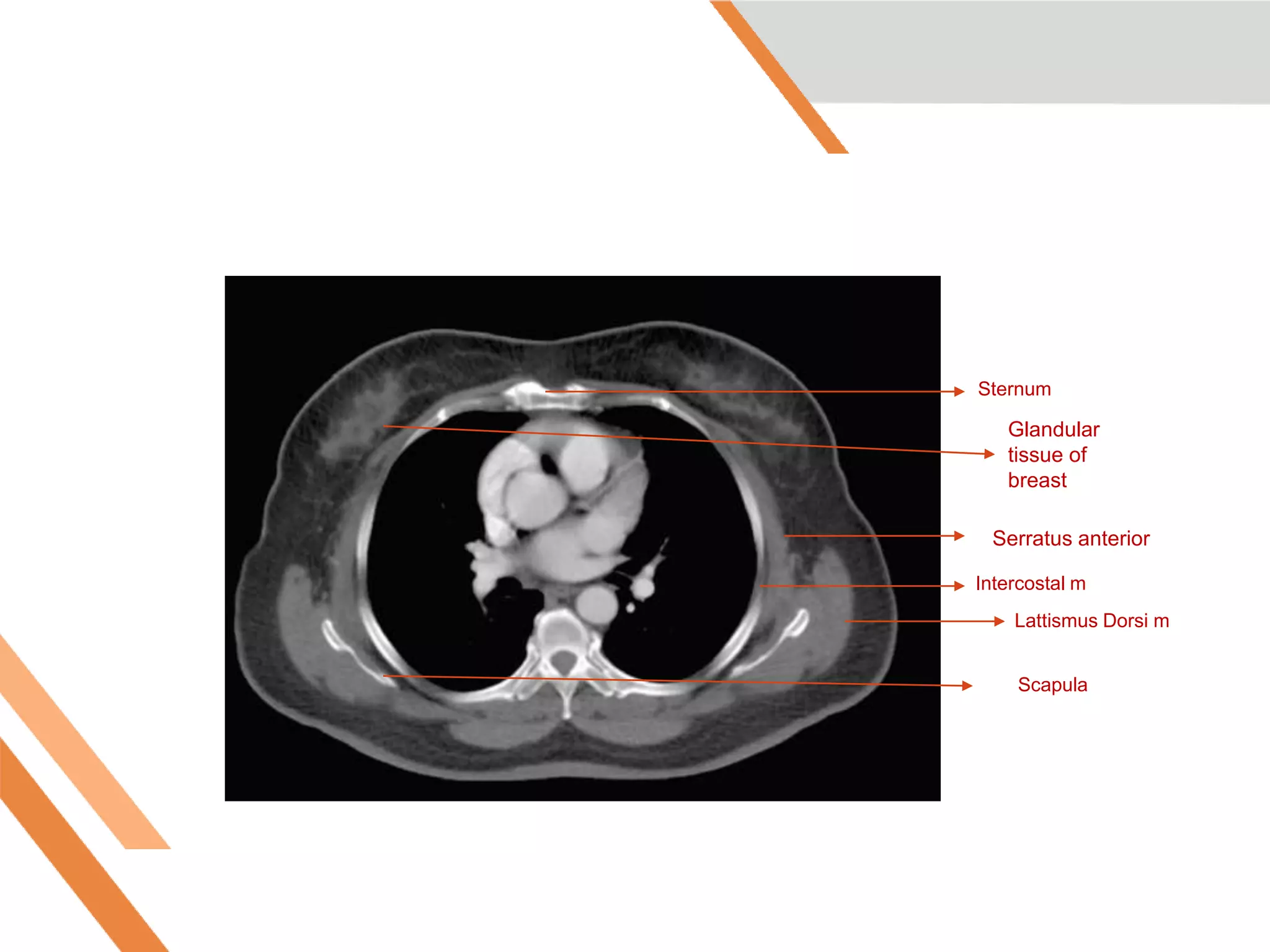 Contouring in breast cancer current practice and future directions | PPTX