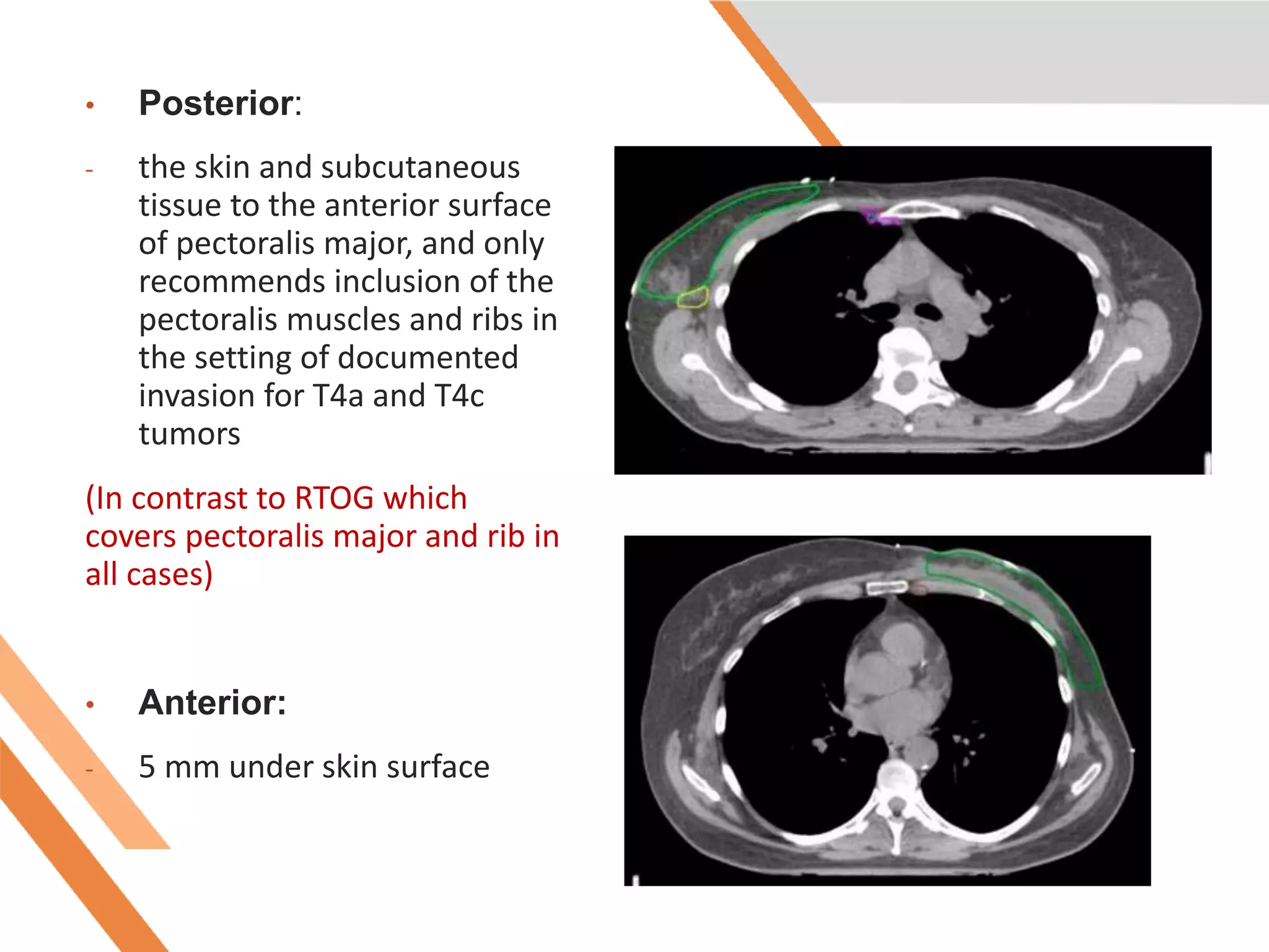 Contouring in breast cancer current practice and future directions | PPTX