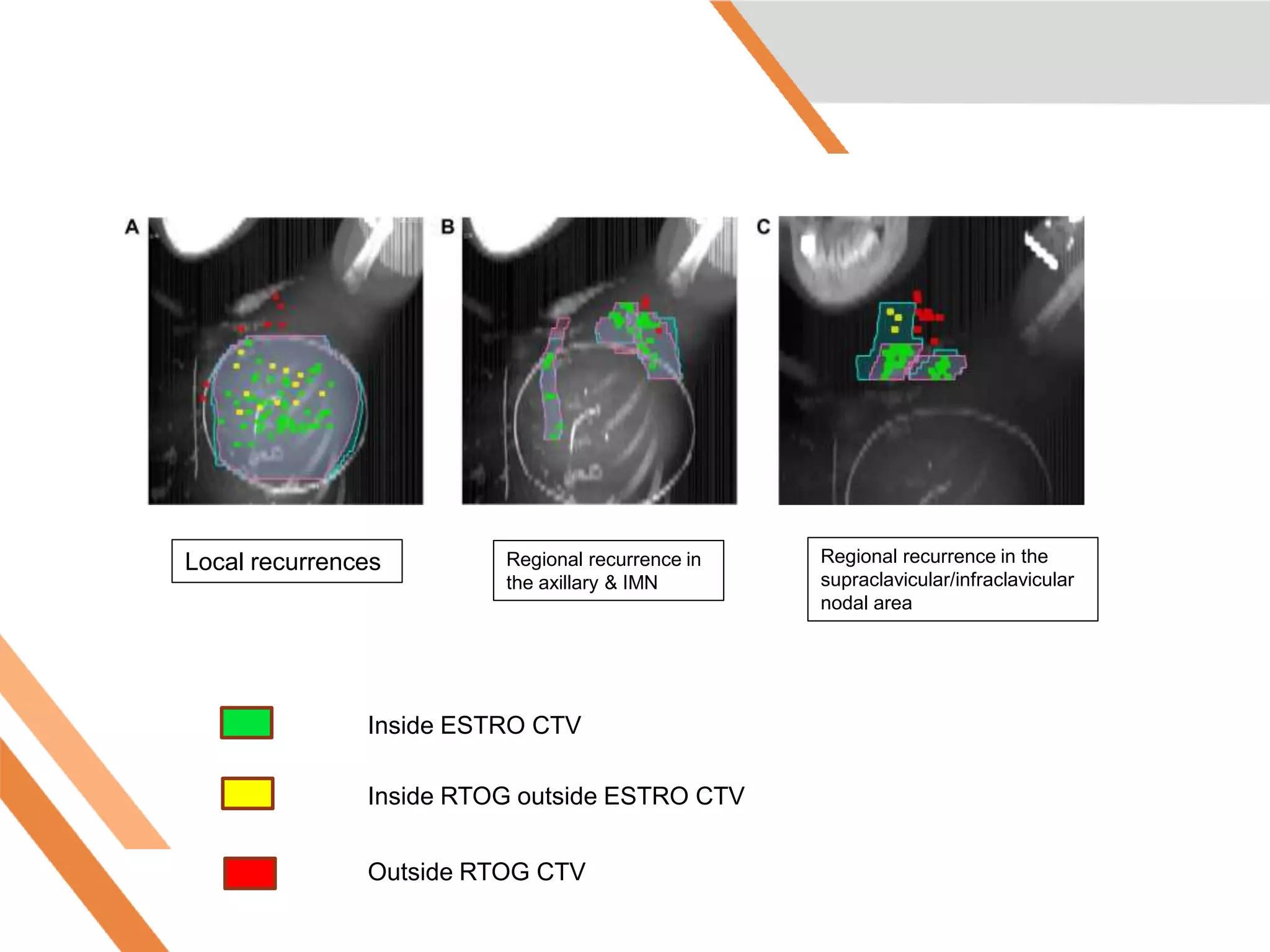 Contouring in breast cancer current practice and future directions | PPTX