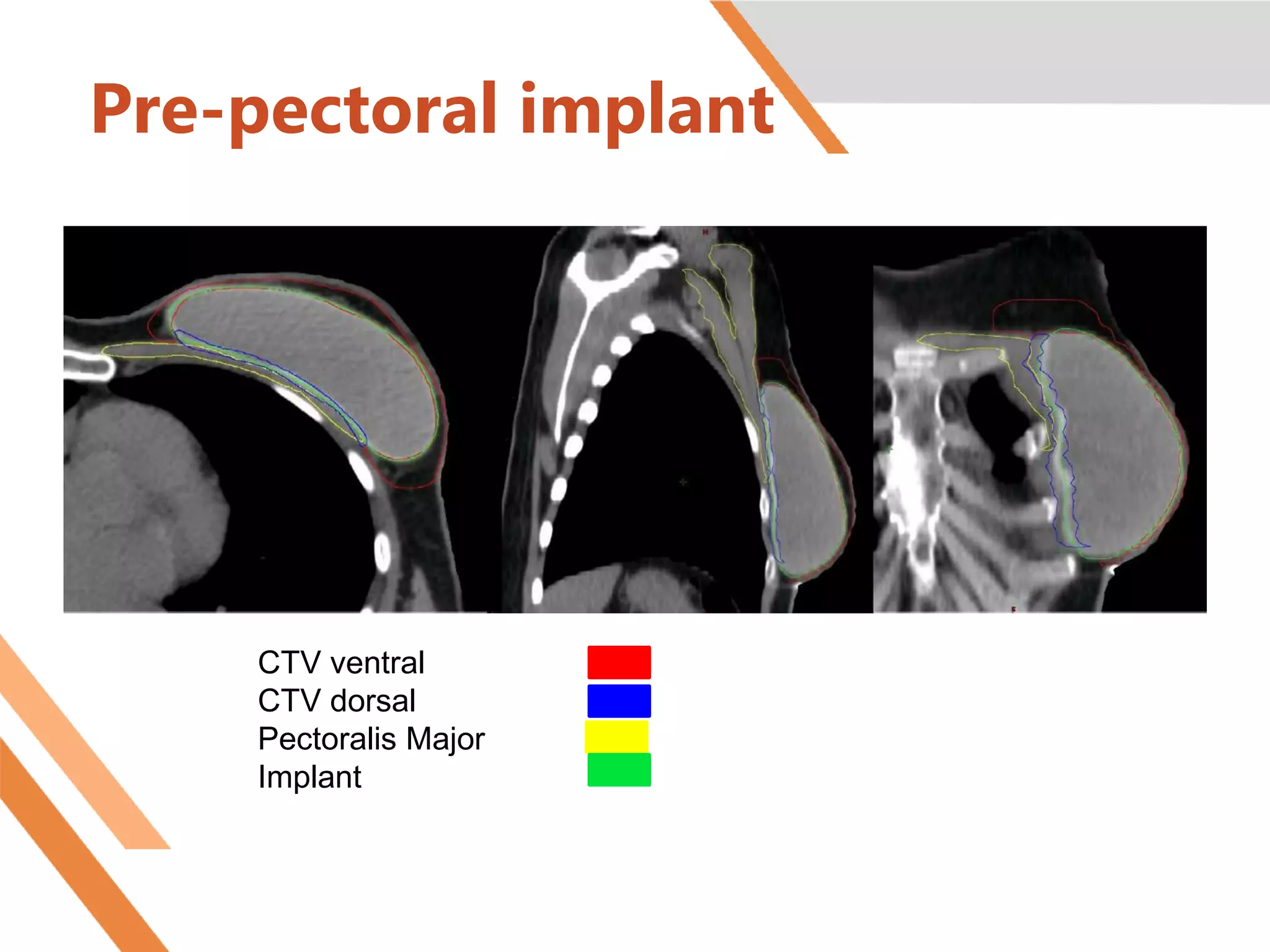 Contouring in breast cancer current practice and future directions | PPTX
