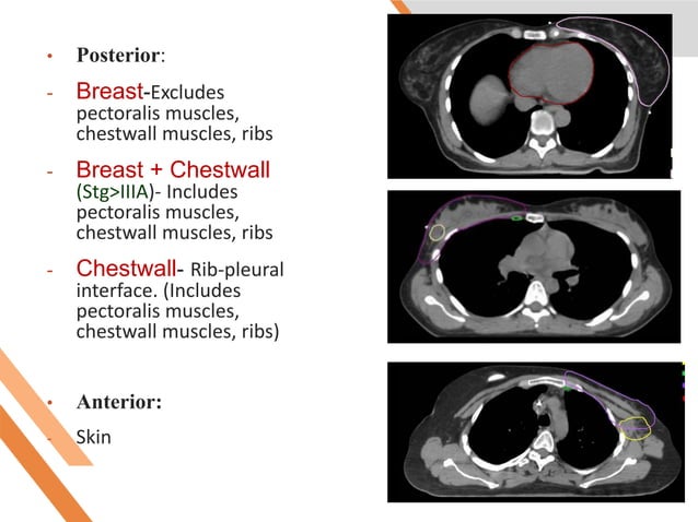 Contouring in breast cancer current practice and future directions ...