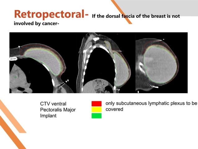 Contouring in breast cancer current practice and future directions ...