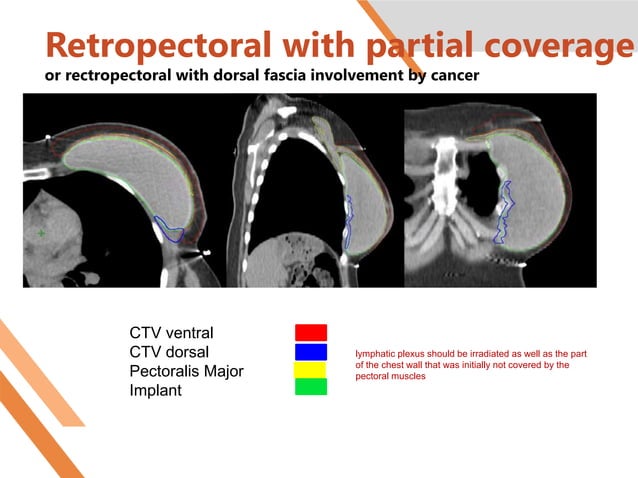 Contouring in breast cancer current practice and future directions ...