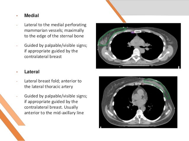 Contouring in breast cancer current practice and future directions