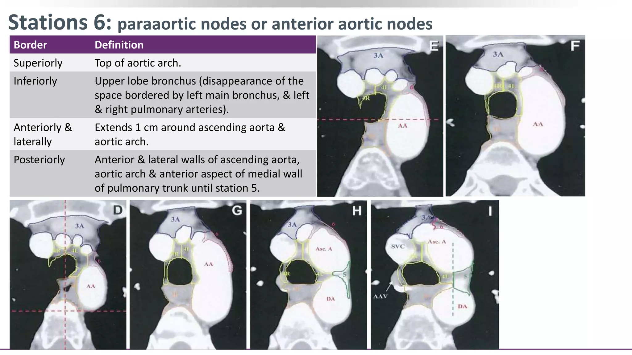Contouring of CTV lymph nodes in NSCLC (Part I) | PPTX