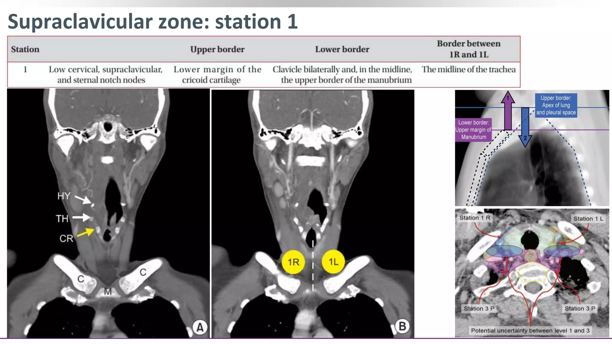 Contouring of CTV lymph nodes in NSCLC (Part I) | PPTX
