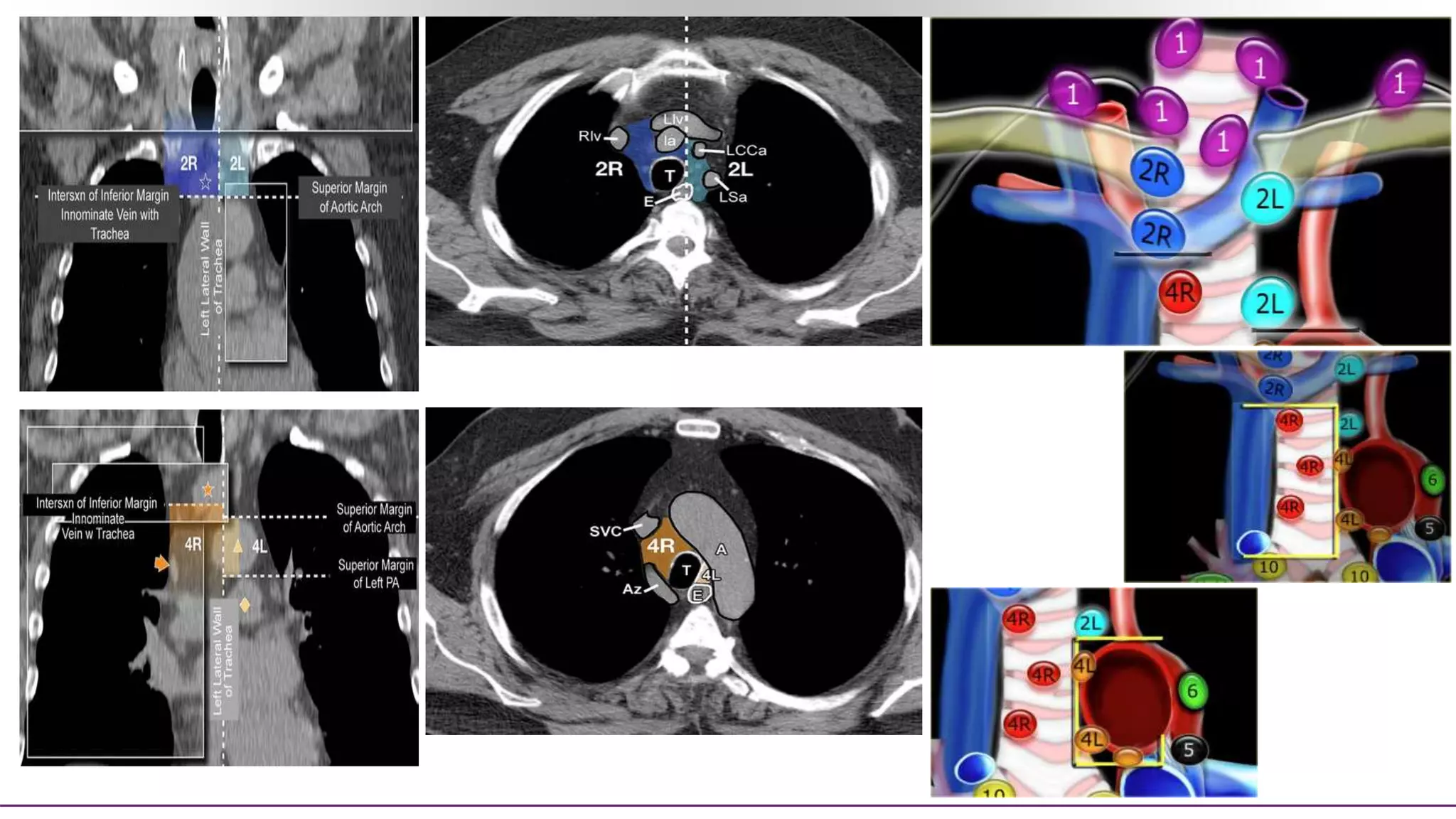 Contouring of CTV lymph nodes in NSCLC (Part I) | PPTX