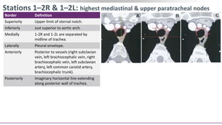 Contouring of CTV lymph nodes in NSCLC (Part I) | PPTX