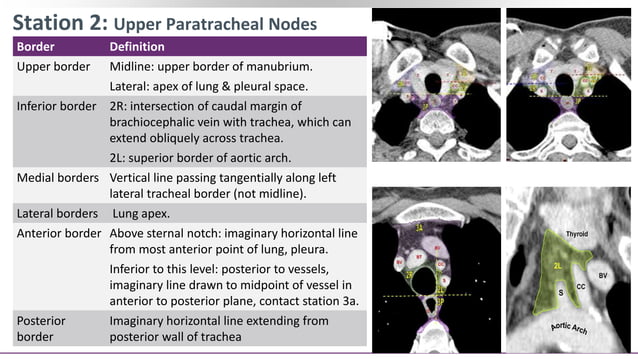 Contouring of CTV Lymph nodes in NSCLC (Part III) | PPT