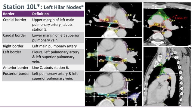 Contouring of CTV Lymph nodes in NSCLC (Part III) | PPT