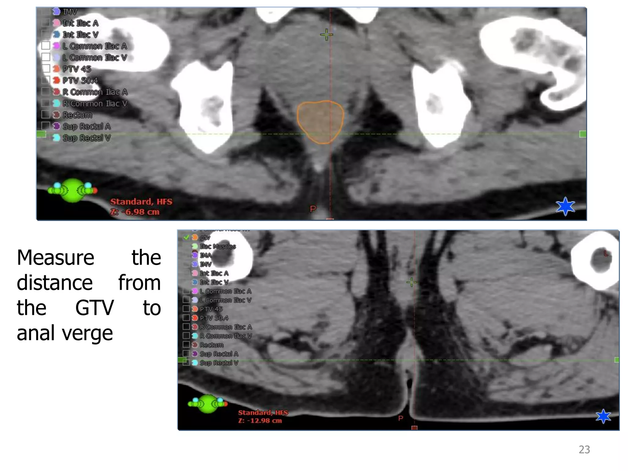Contouring rectal cancers | PDF