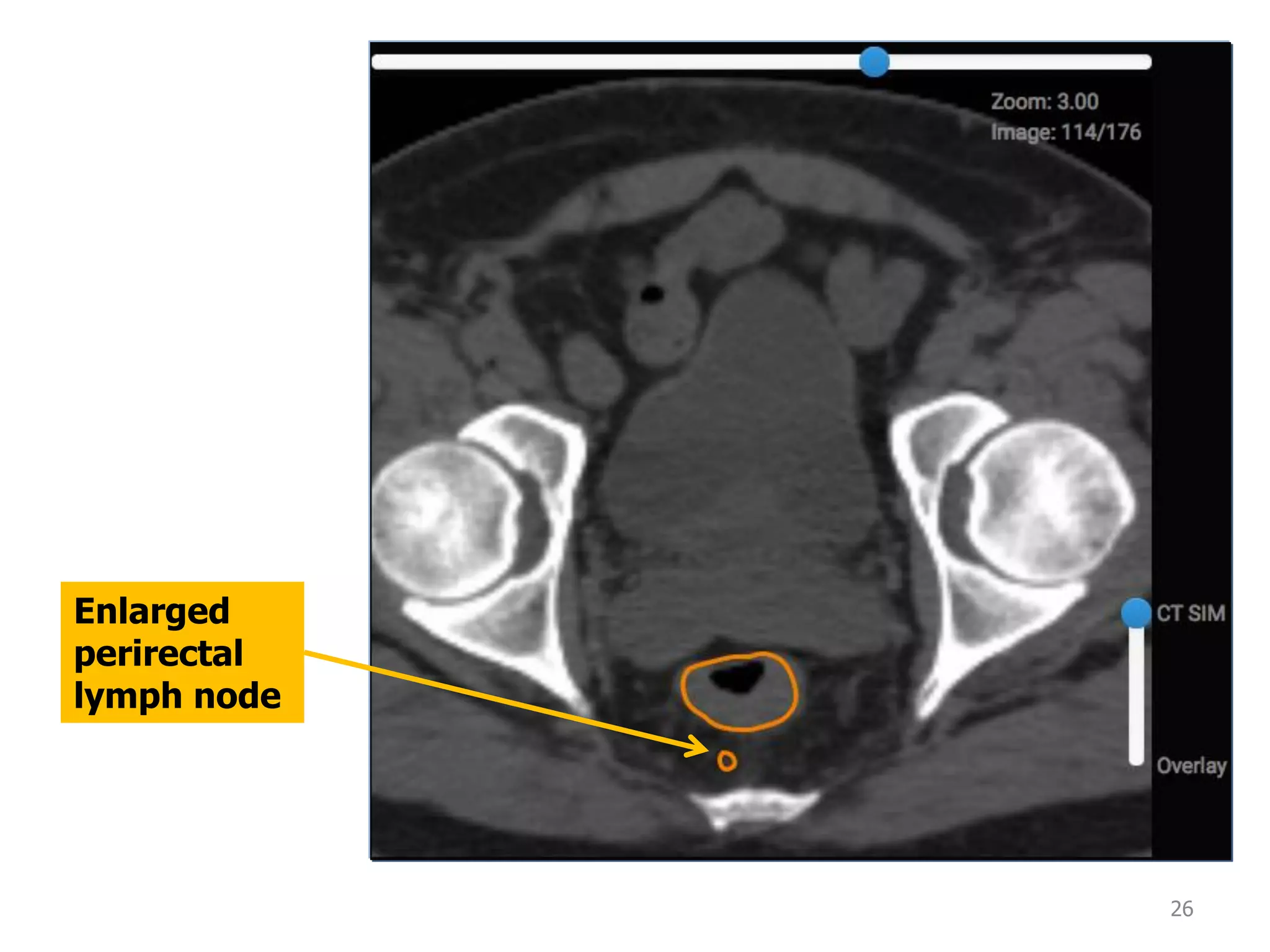 Contouring rectal cancers | PDF