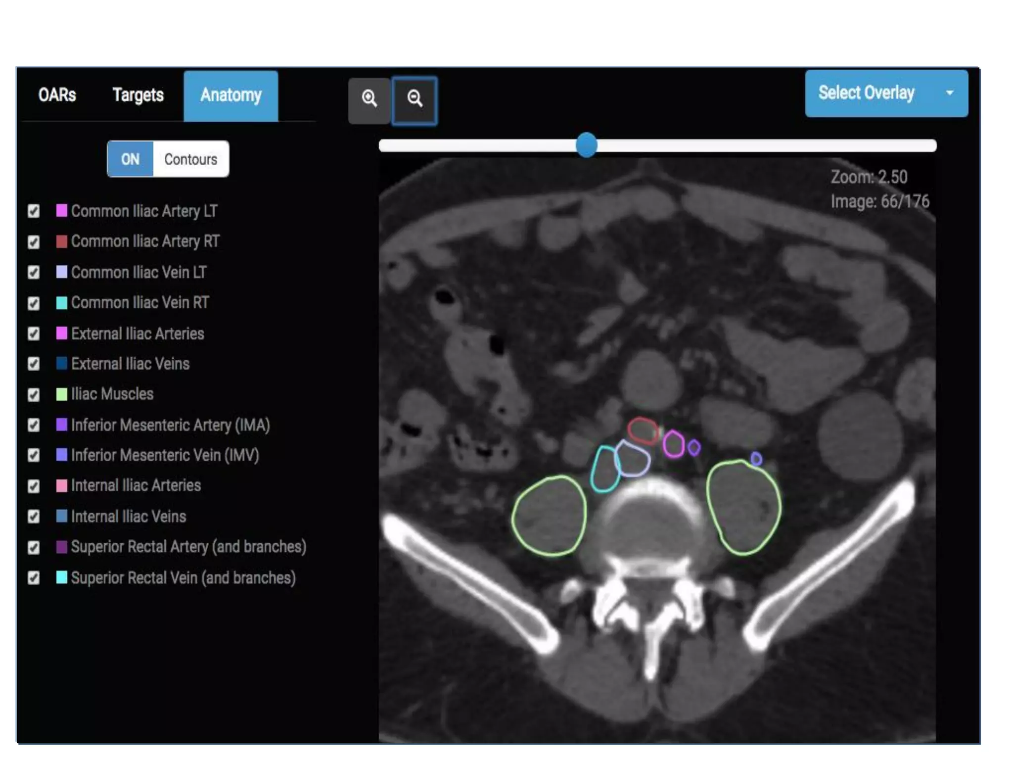 Contouring rectal cancers | PDF