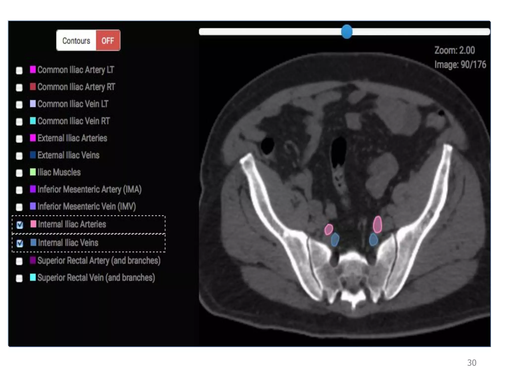 Contouring rectal cancers | PDF