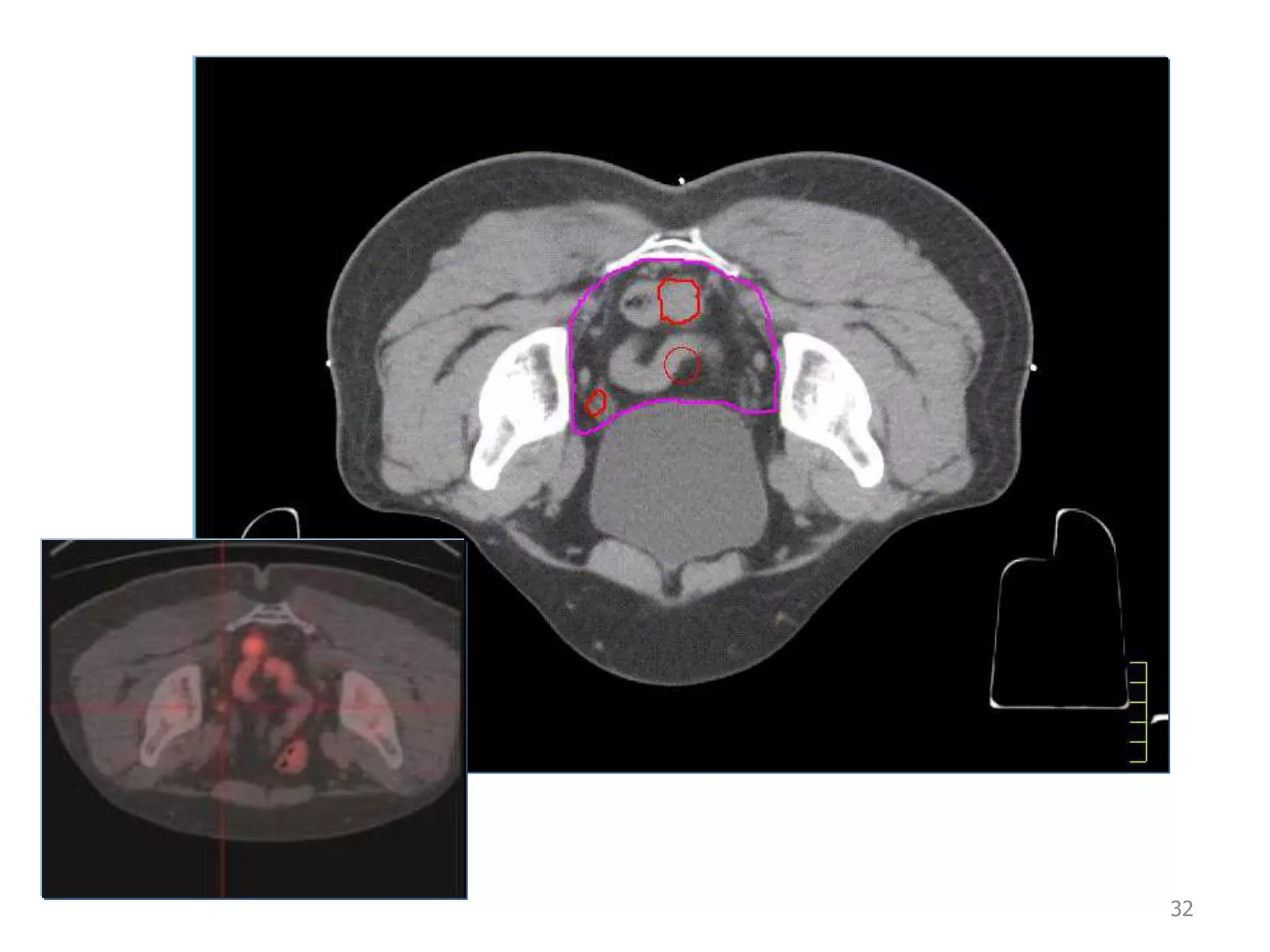 Contouring rectal cancers | PDF