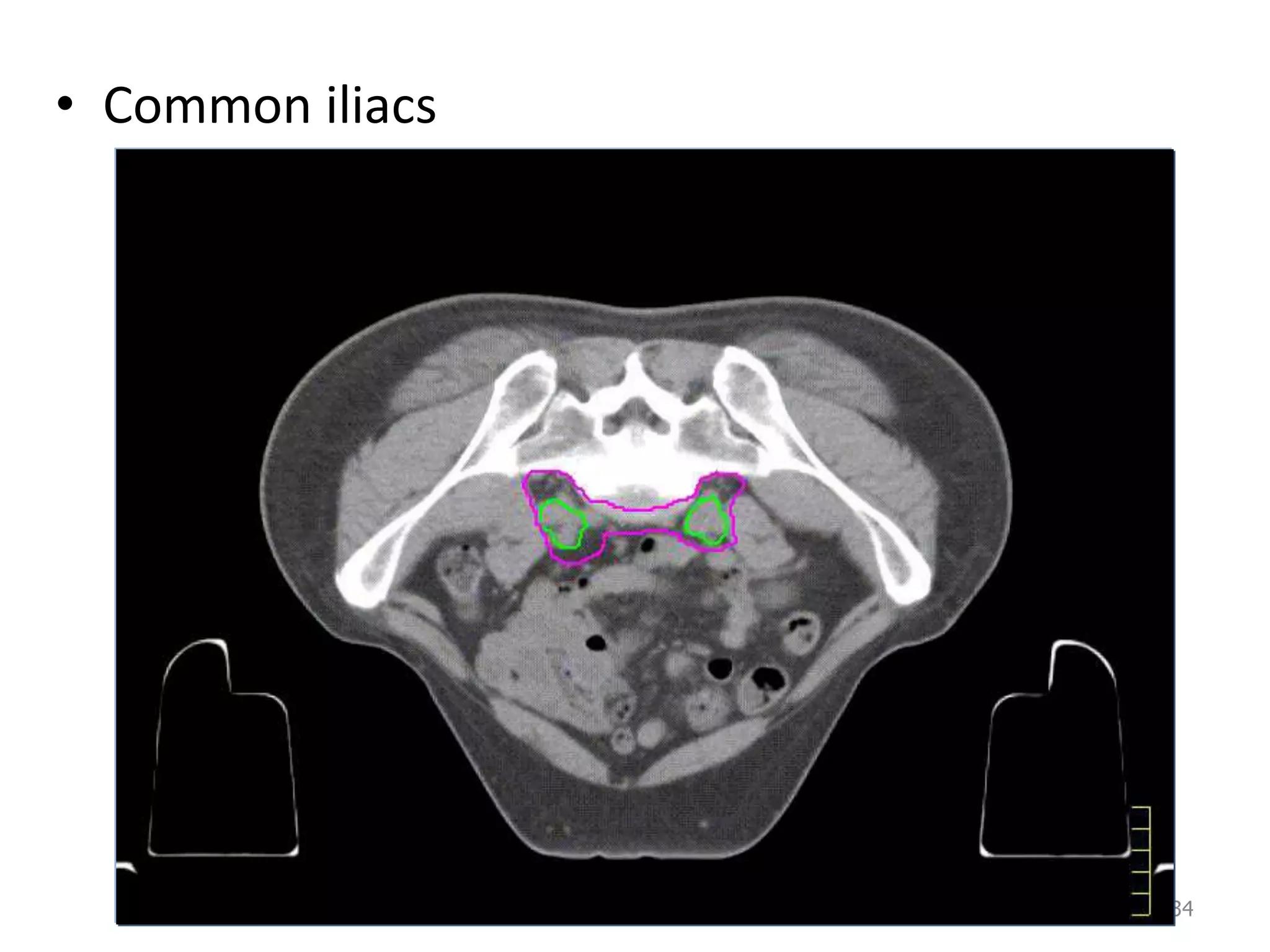 Contouring rectal cancers | PDF