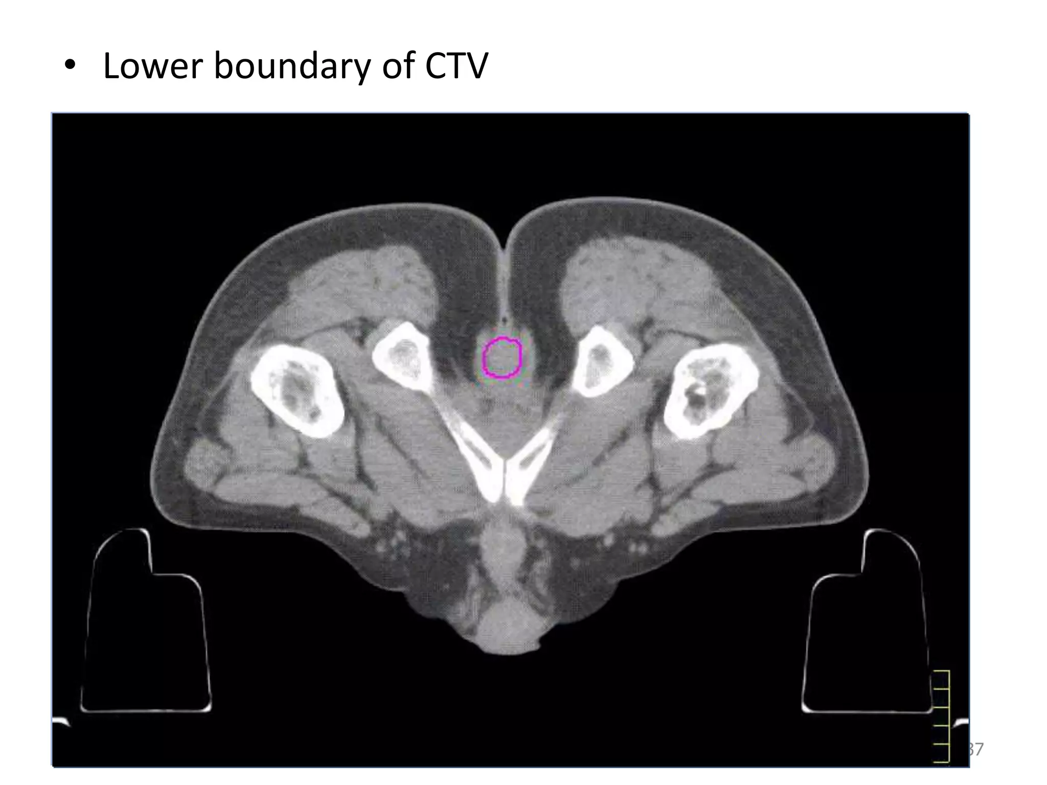Contouring rectal cancers | PDF