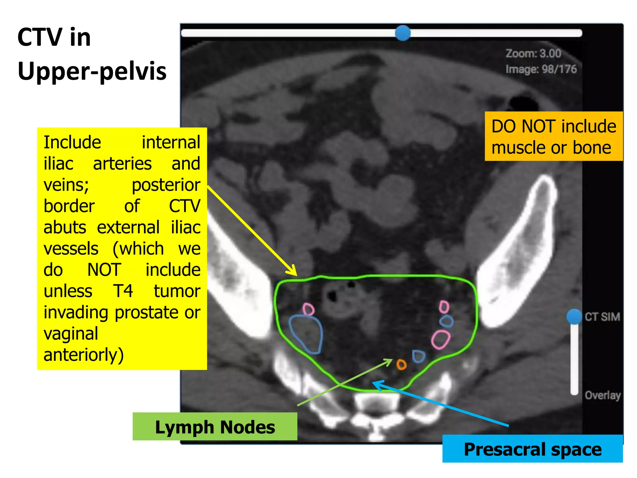 Contouring rectal cancers | PDF