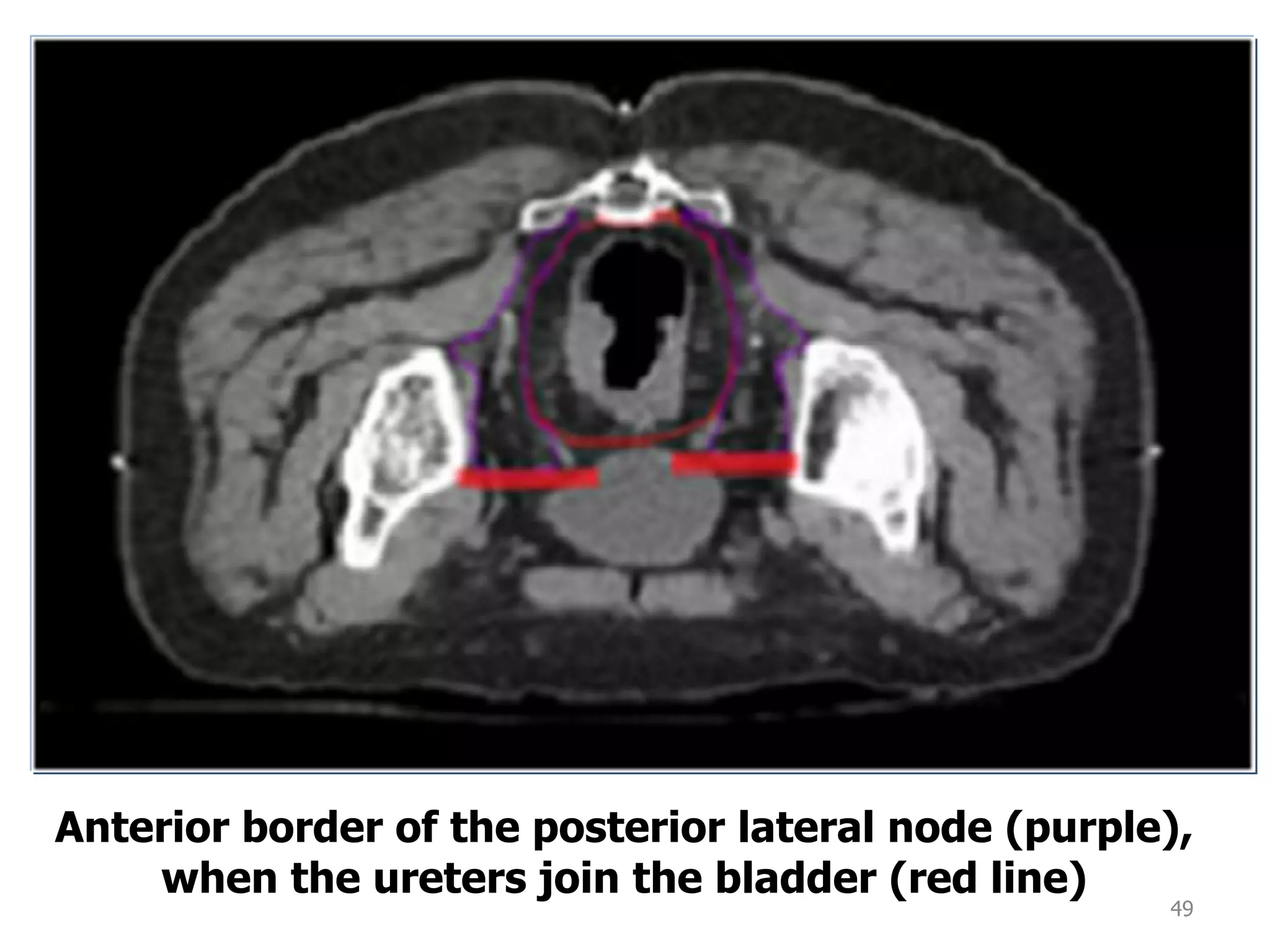Contouring rectal cancers | PDF