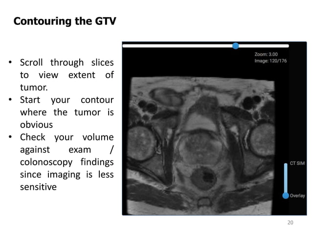 Contouring rectal cancers | PDF