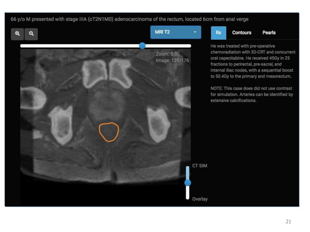 Contouring rectal cancers