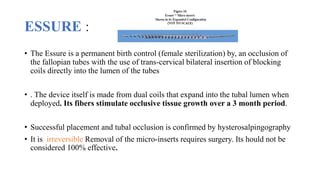 Newer techniques of sterilization & contraception ,injectable ...