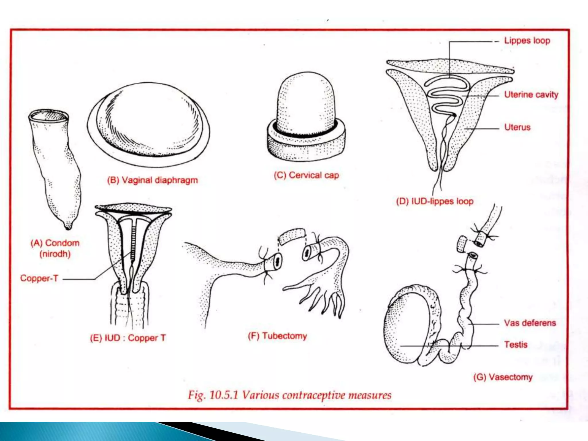 Contraception - Overview | PPTX