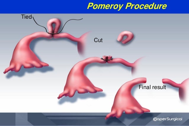 METHODS OF CONTRACEPTION