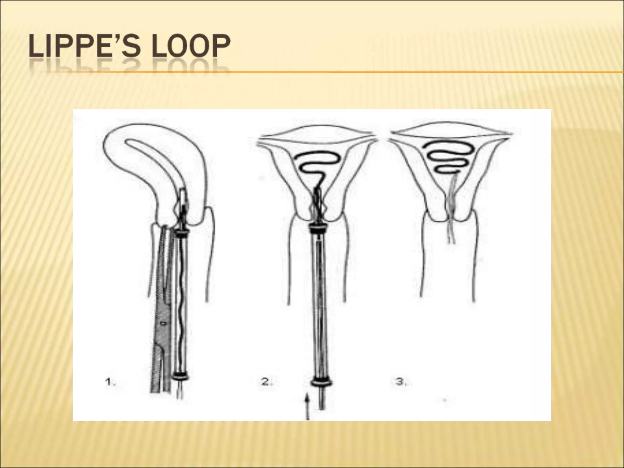Contraceptive devices | PPT