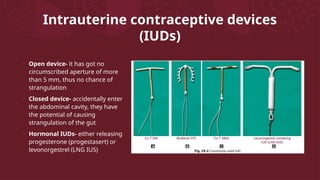CONTRACEPTIVE METHODS, etiology, symptoms, treatment | PPT